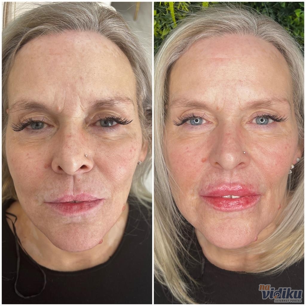 Bezmetalne i metalne krunice, Dental Aesthetica slike