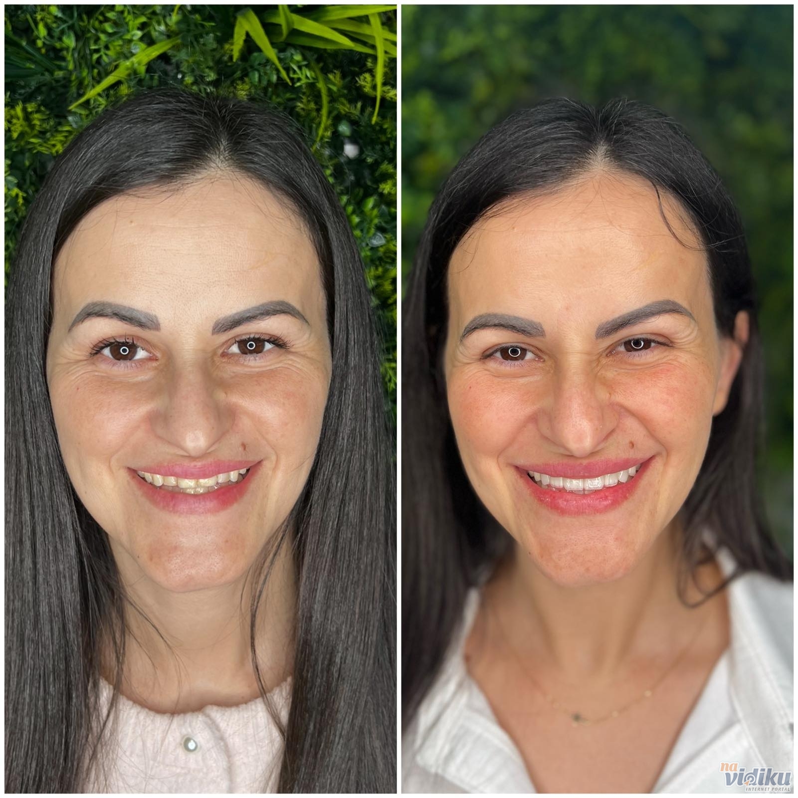 Bezmetalne i metalne krunice, Dental Aesthetica slike