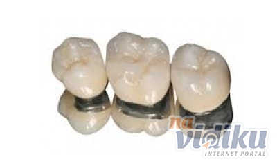 Izrada metalo-keramičke krunice - Dental studio Dro - akcije, kuponi ...